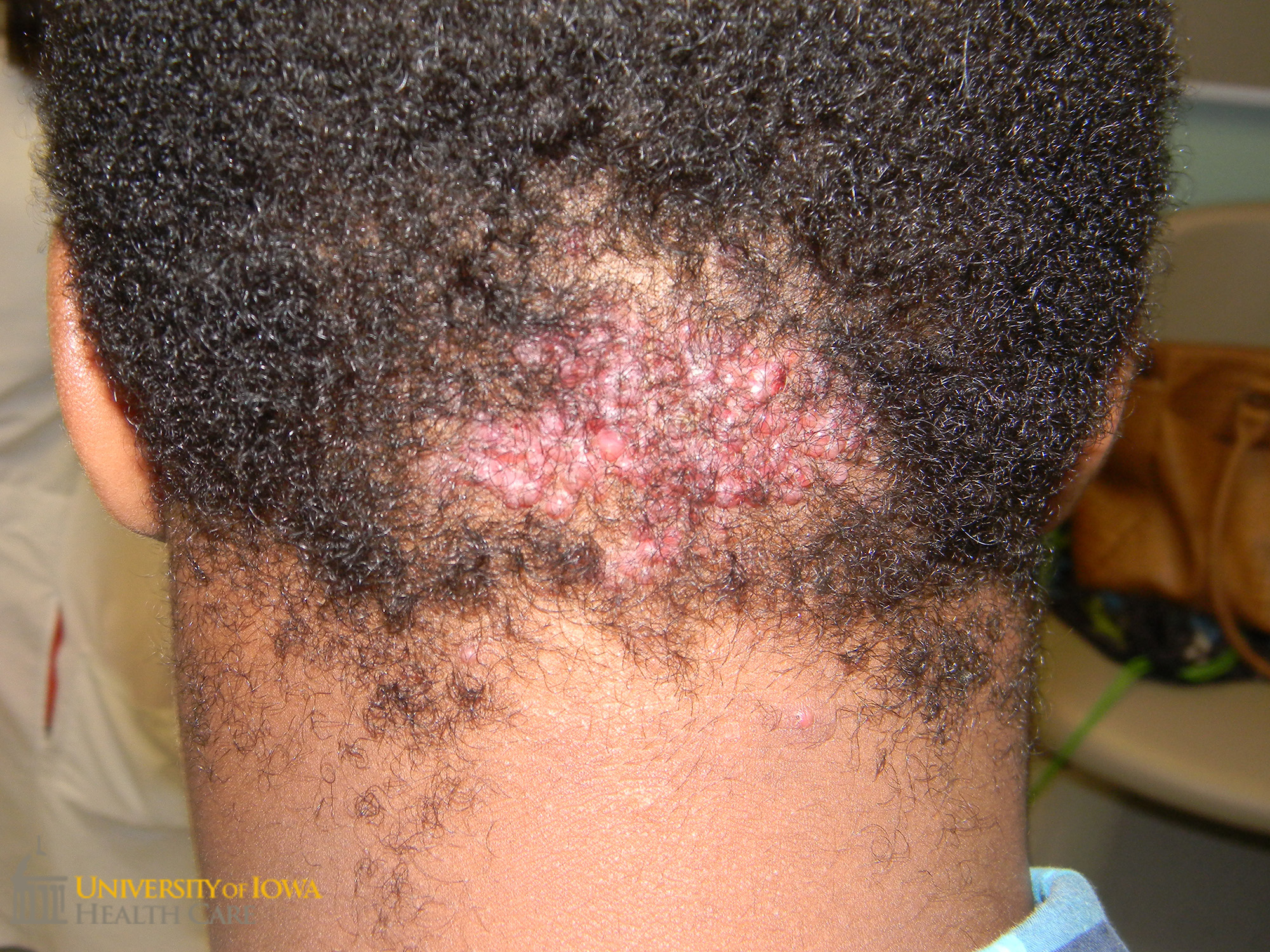 Grouped pink keloidal papules on the occipital scalp. (click images for ...