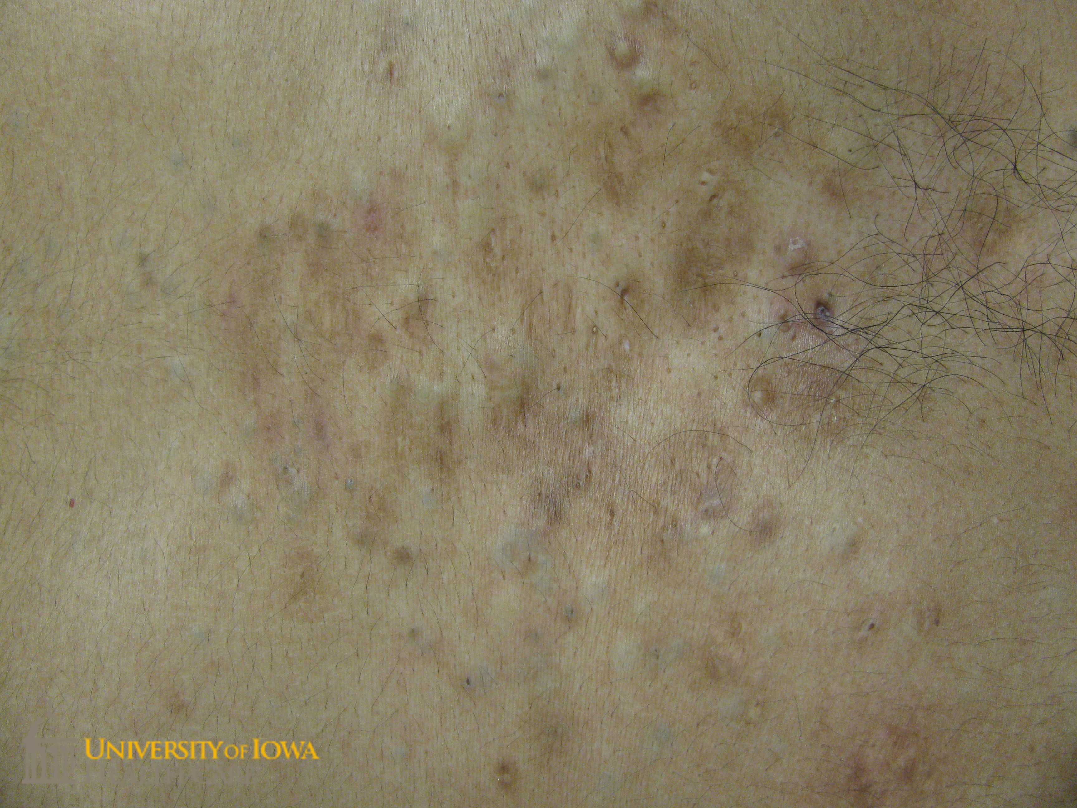Multiple gray, brown, and skin-colored papules on the chest. (click ...