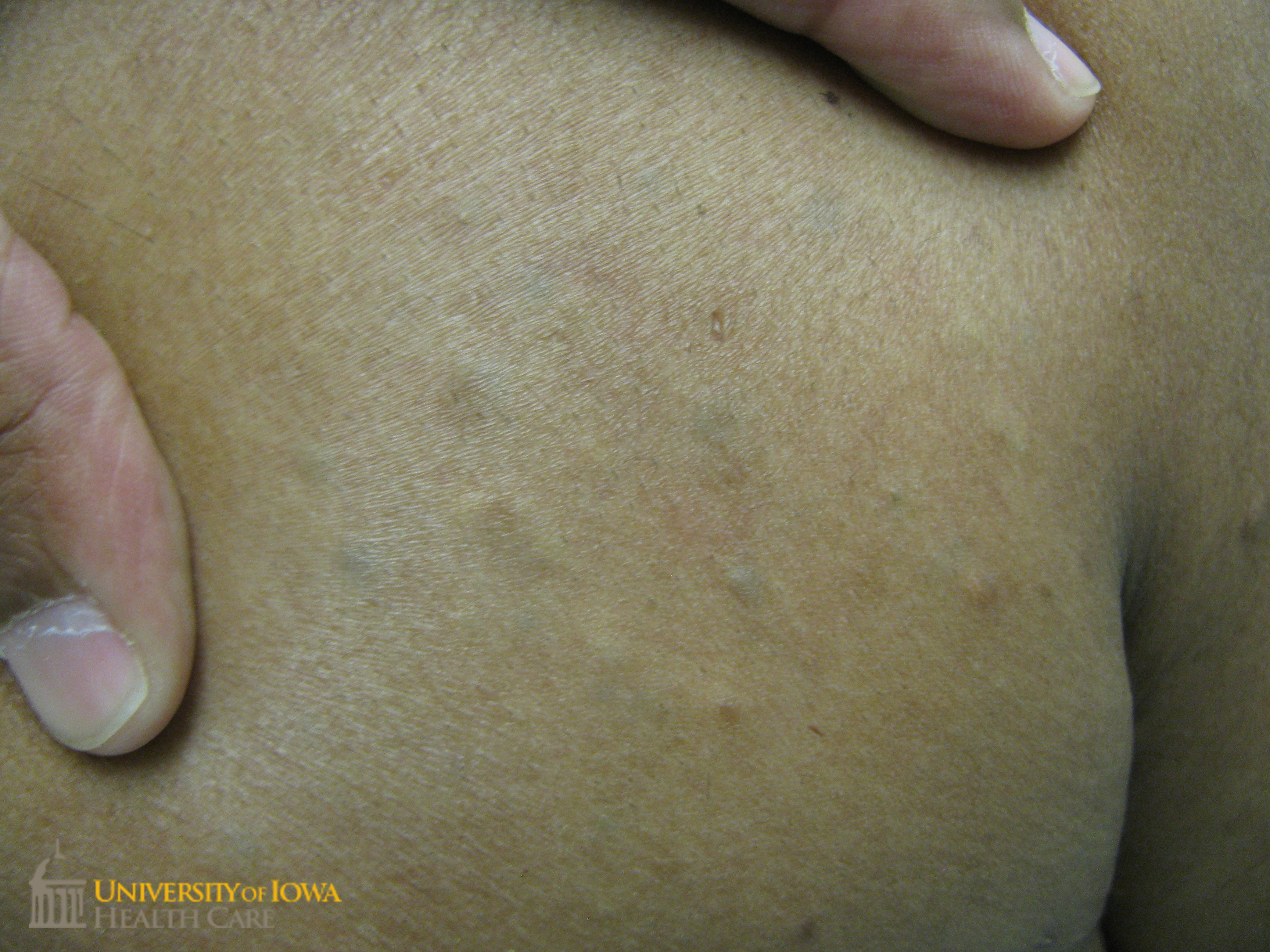 Multiple gray and yellow papules on the trunk. (click images for higher ...