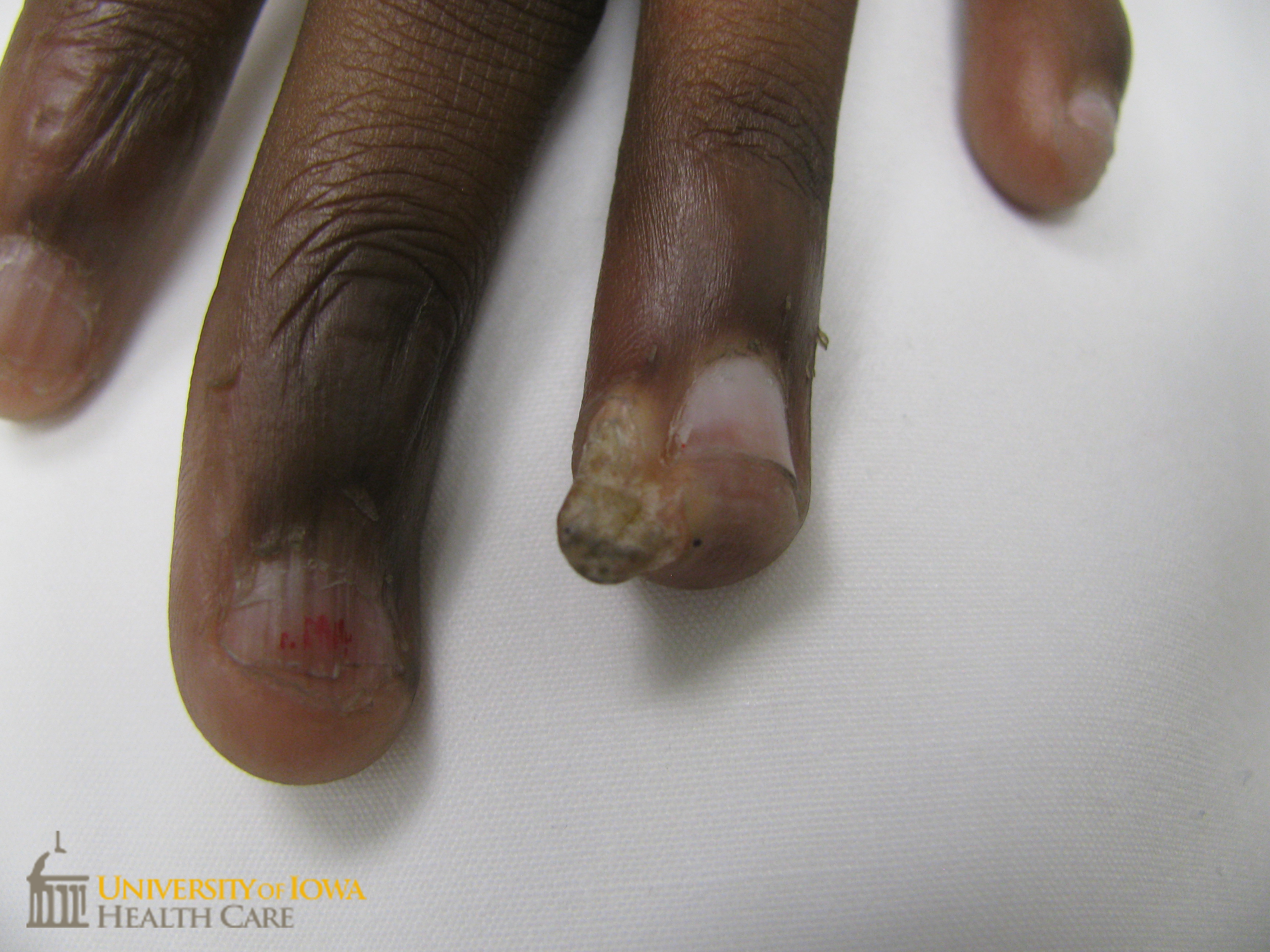 Yellow, rock-like nodule on the medial 4th distal digit. (click images ...