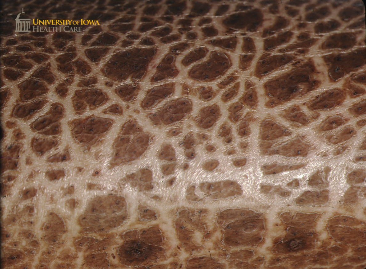 Icthyotic hyperpigmented plate-like scale on the extremity. (click ...