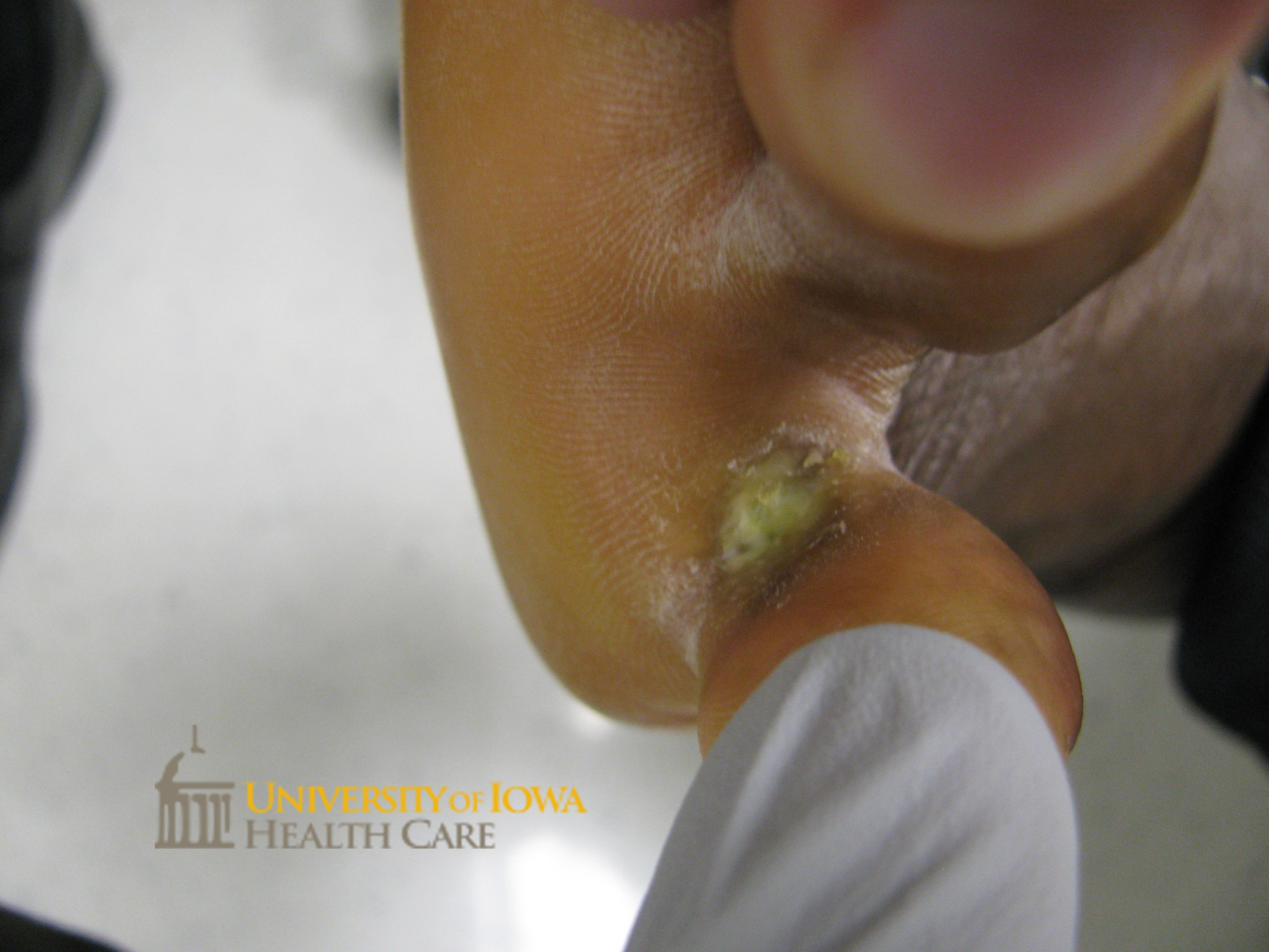 White plaque with surrounding hyperpigmentation on the toe web space ...
