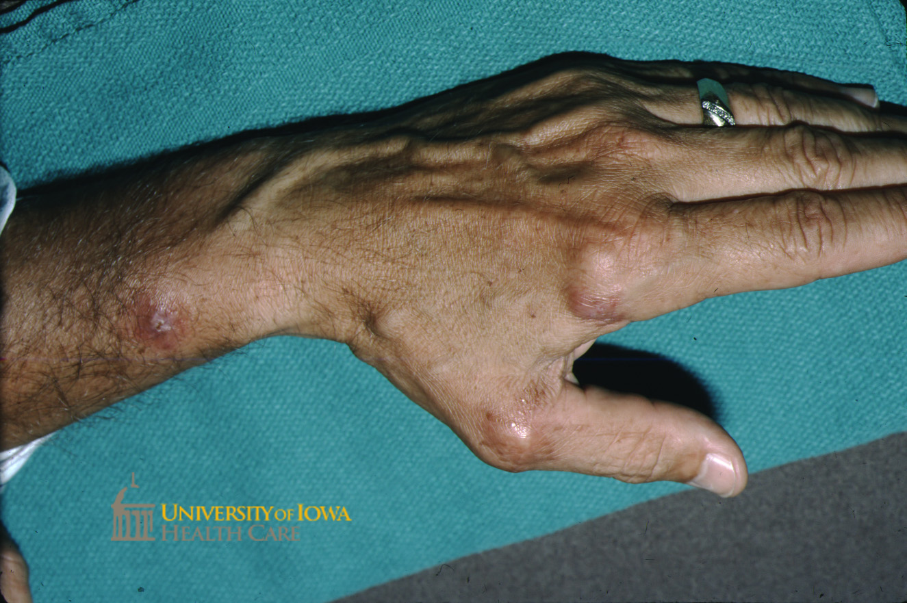 Skin-colored to erythematous nodules on the dorsal hand and arm. (click ...