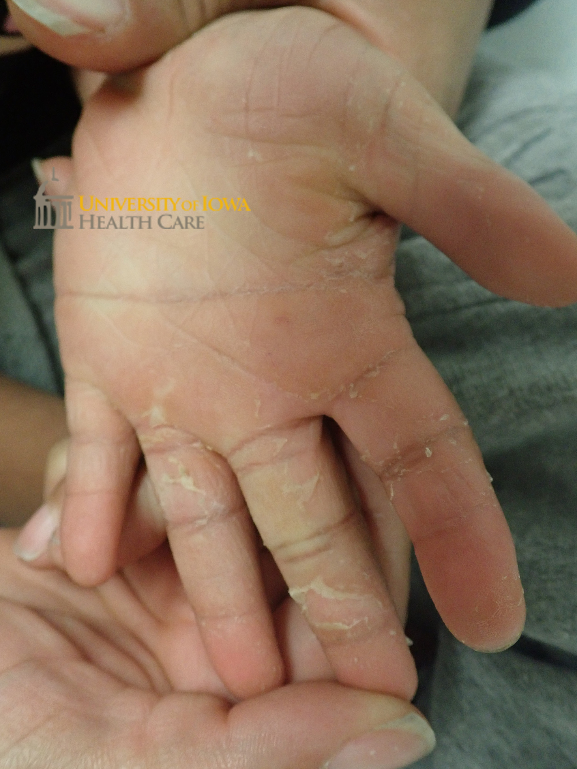 Superficial desquamation of the palm . (click images for higher ...