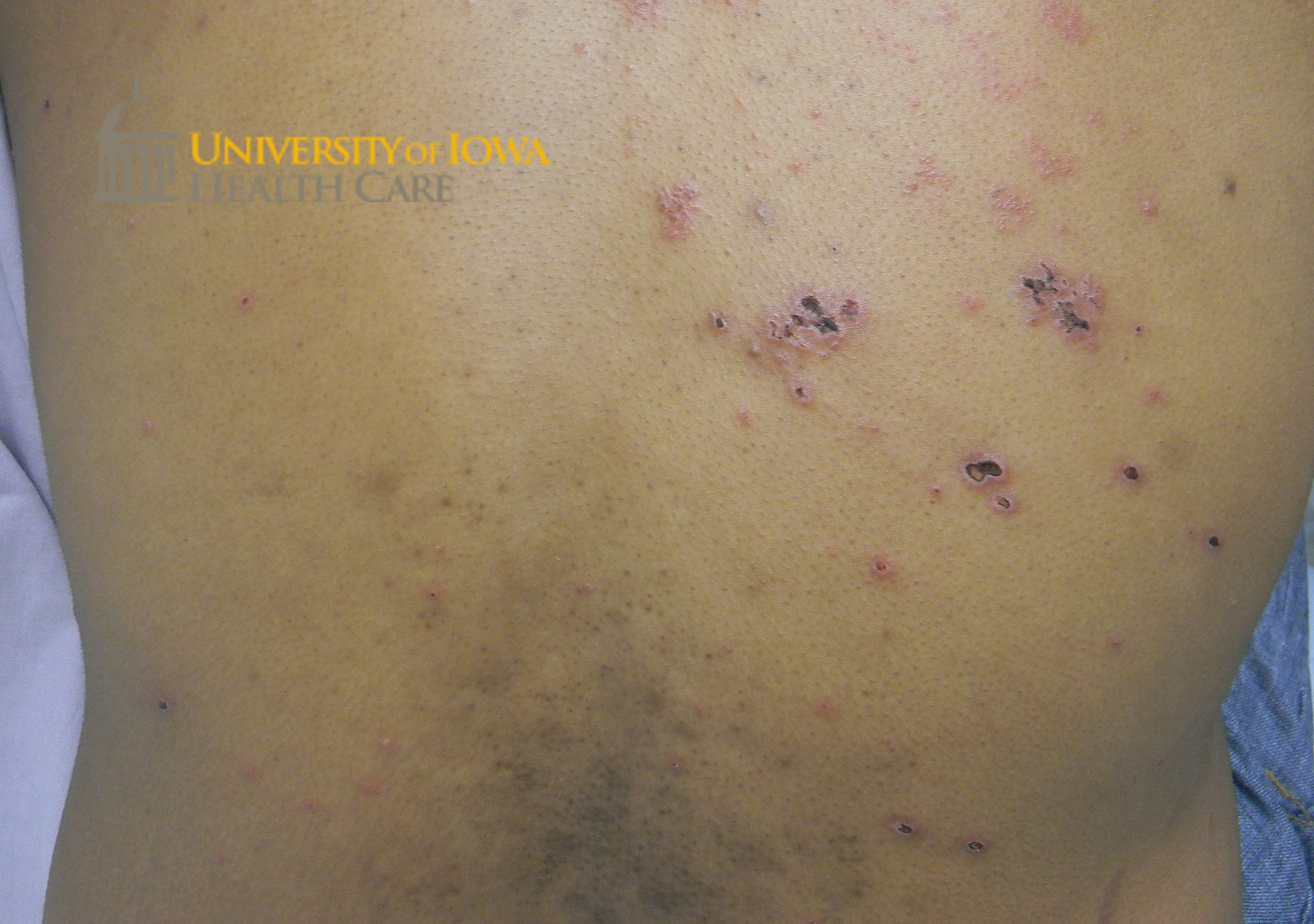 Many pink papules and vesicles, some with central erosion and some with ...