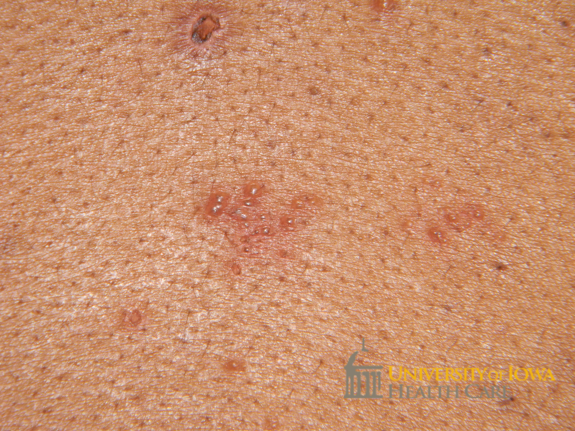 Grouped vesicles, one with central crusting, on the back. (click images ...