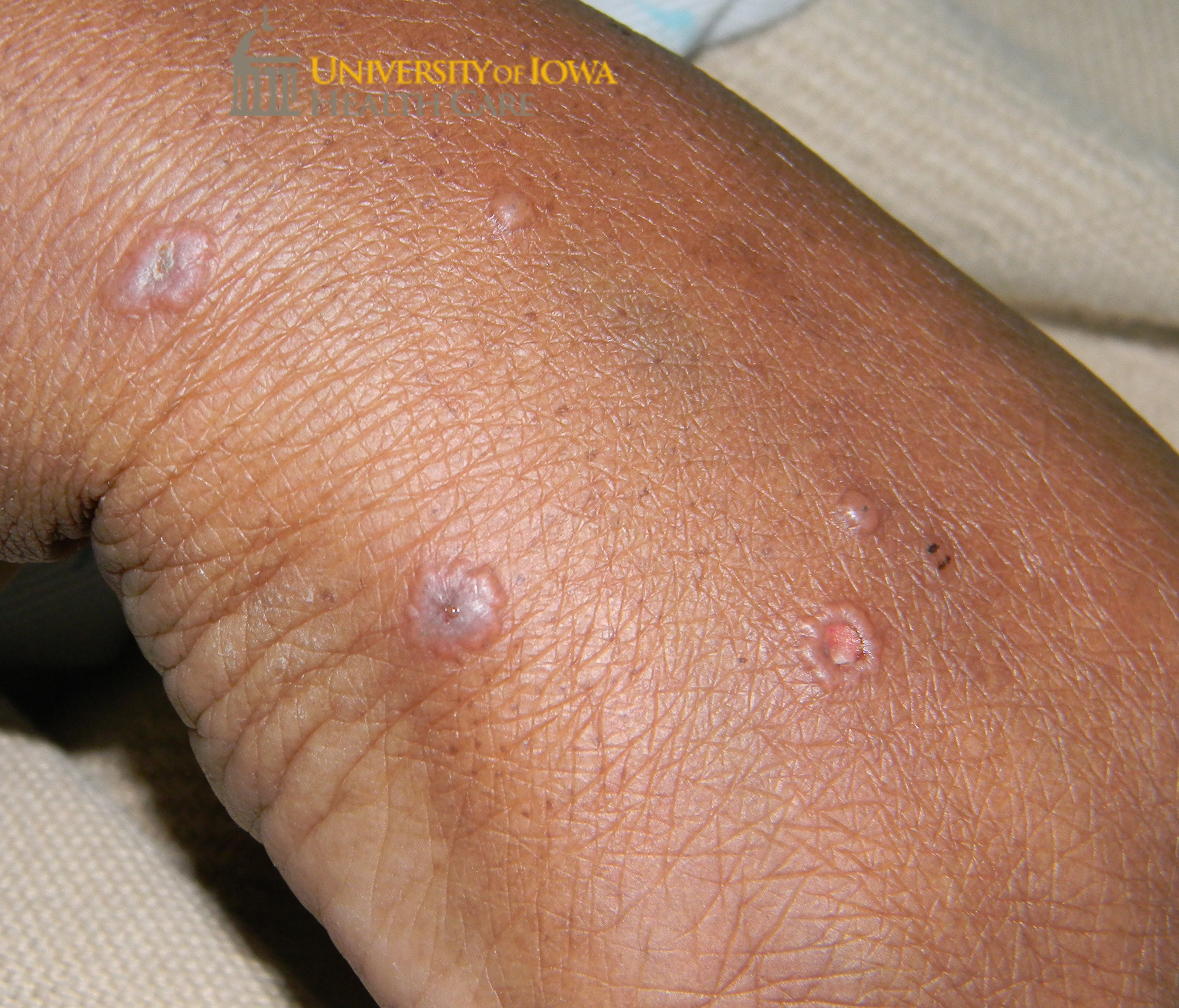 Many pink papules and vesicles, some with central erosion and ...