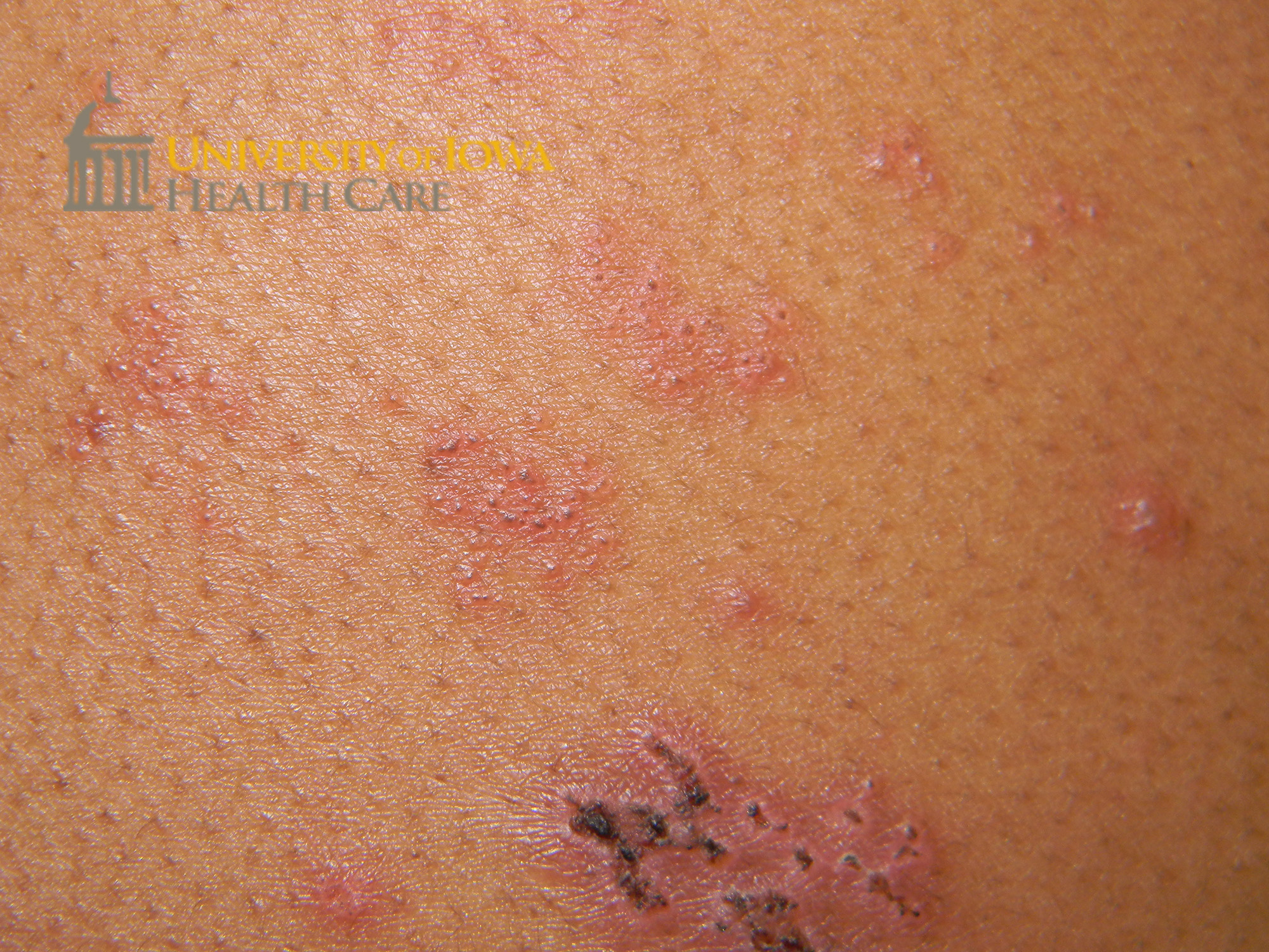 Erythematous and pink grouped vesicles, some with central hemecrusting ...