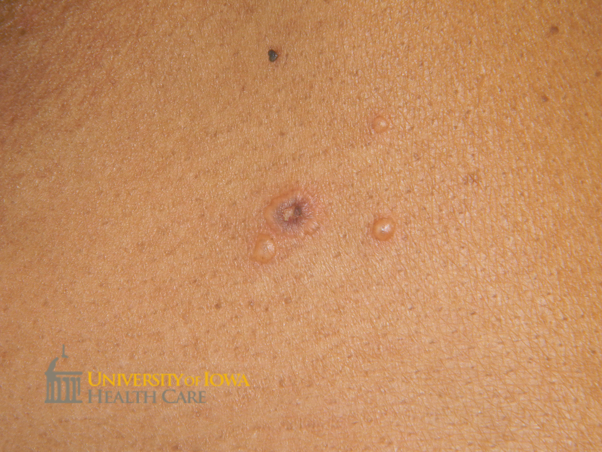 Vesicles with one with central umbilication. (click images for higher ...