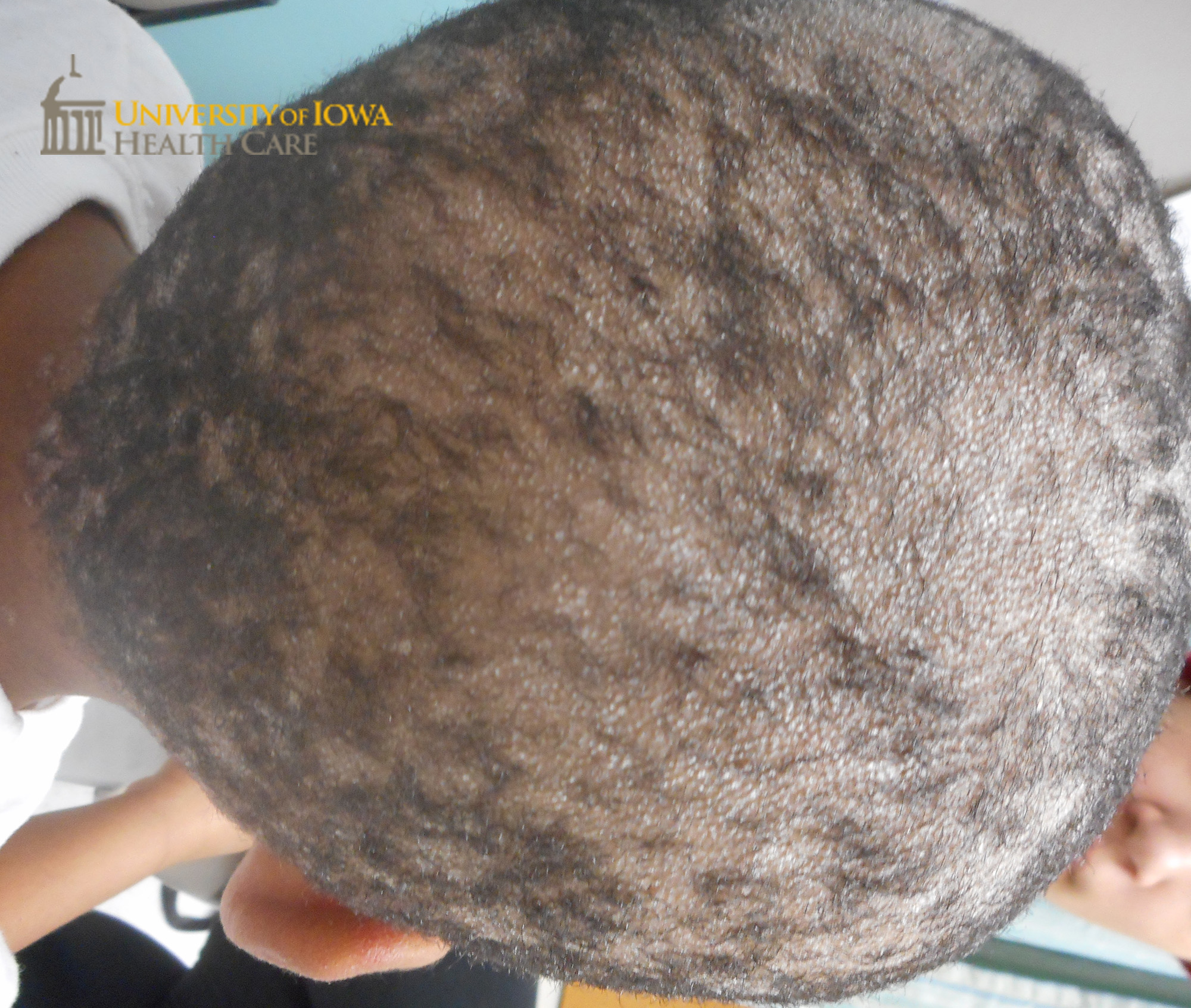 Scaly alopetic patches on the scalp. (click images for higher resolution).