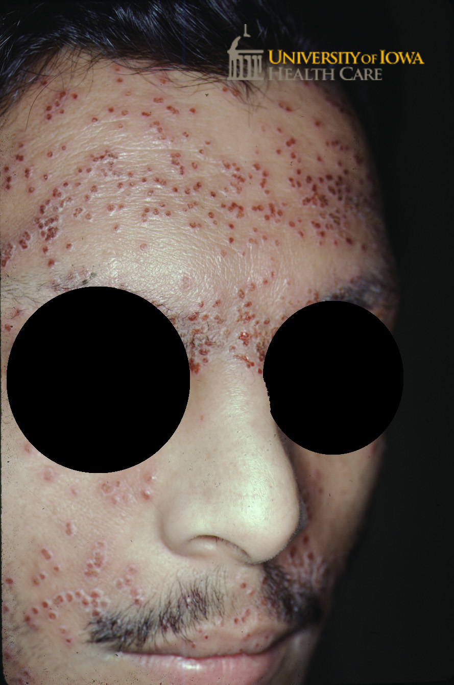 Many monomorphic discreet papules with central crust and vesicles ...