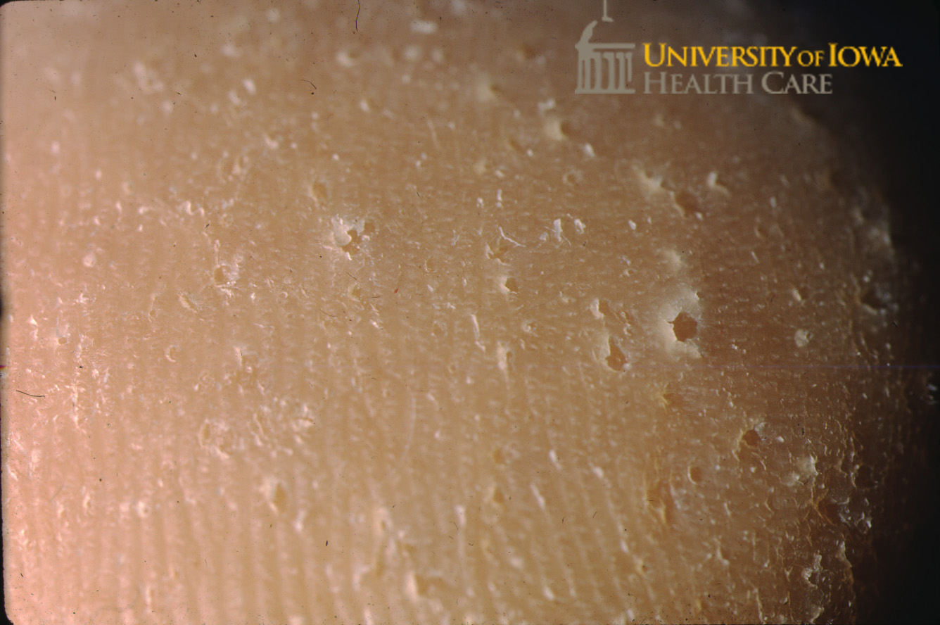 Multiple discreet keratin pits on the plantar foot. (click images for ...