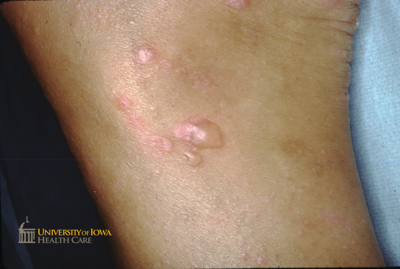 Flat topped pink papules with overlying bullae on the extremity. (click ...
