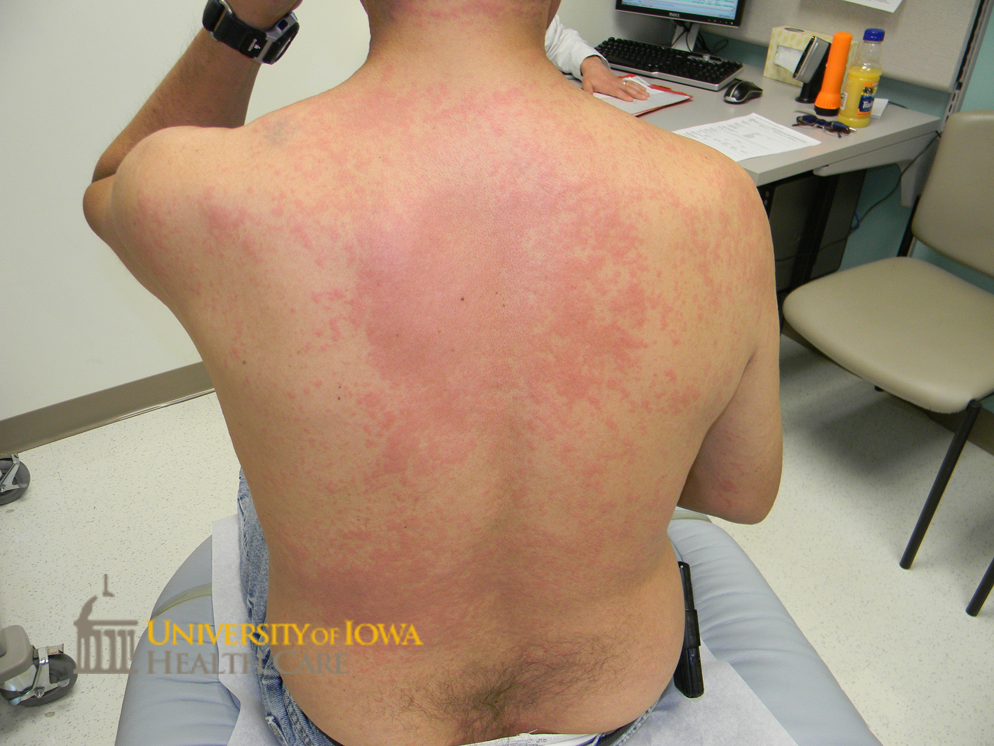 Brightly erythematous papules coalescing into plaques on the back ...