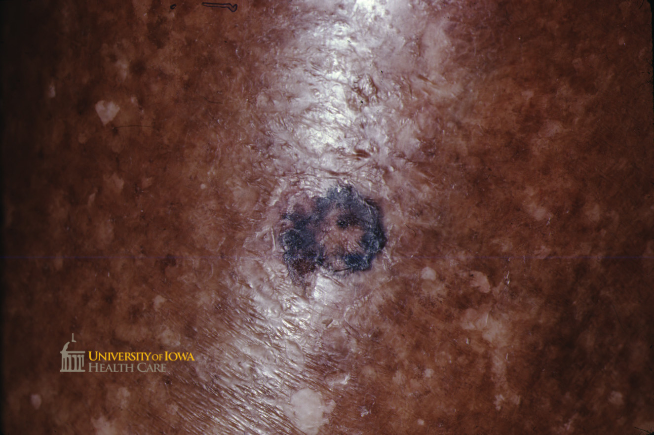 Violaceous and pink scaly plaque. (click images for higher resolution).