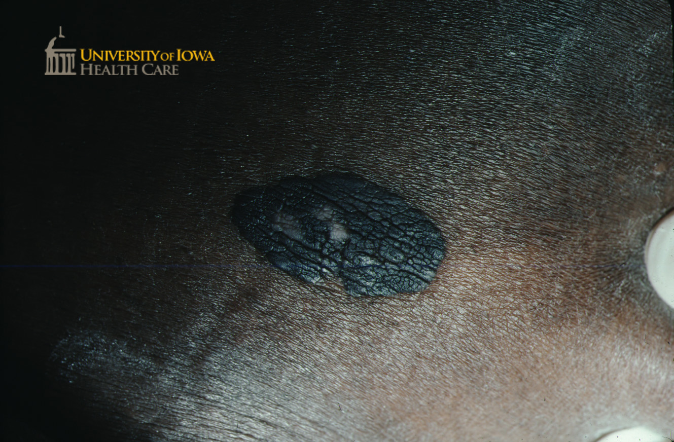 Verrucous plaque on the penile shaft. (click images for higher resolution).