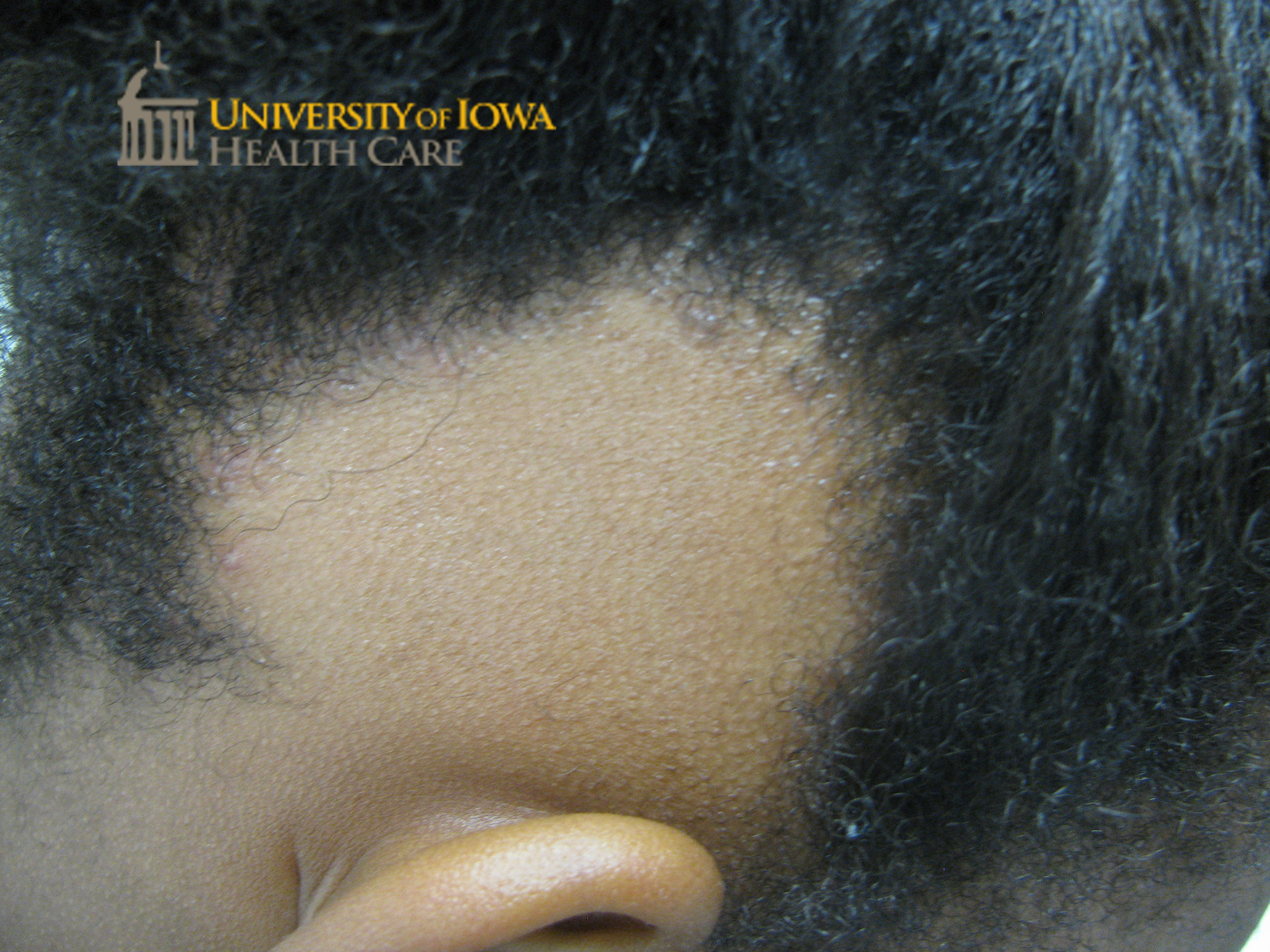 Round patch of nonscarring alopecia on the scalp. (click images for ...