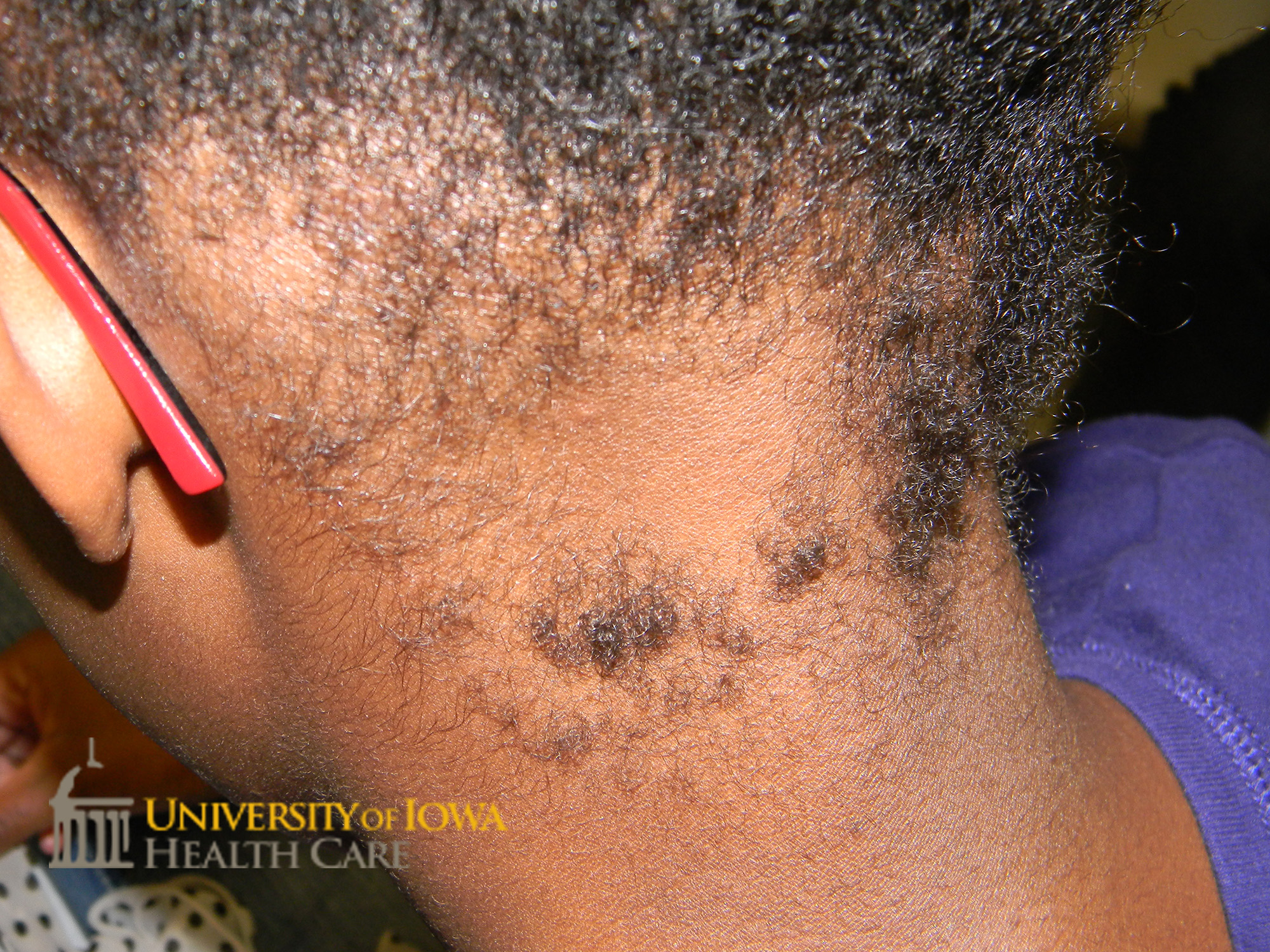 Multiple round patches of nonscarring alopecia on the scalp. (click ...