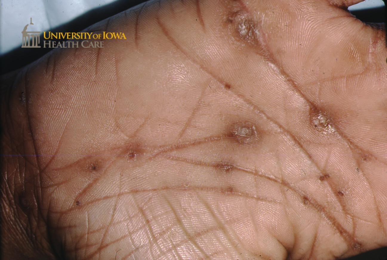 Hyperpigmented pits and keratotic papules along the palmar creases ...