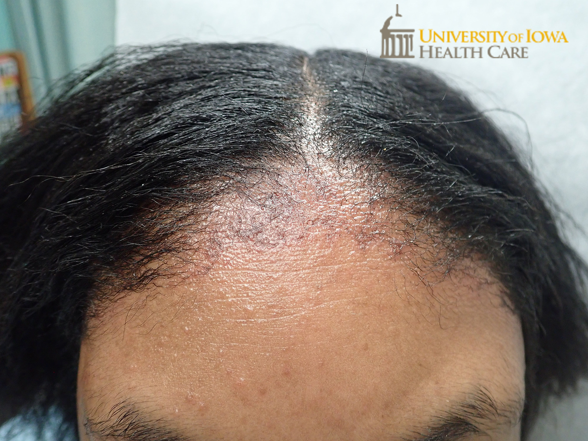 Erythematous papules with surrounding erythema on the frontal scalp ...