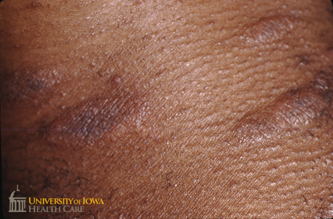 Erythematous to violaceous ovoid plaques and papules on the abdomen ...