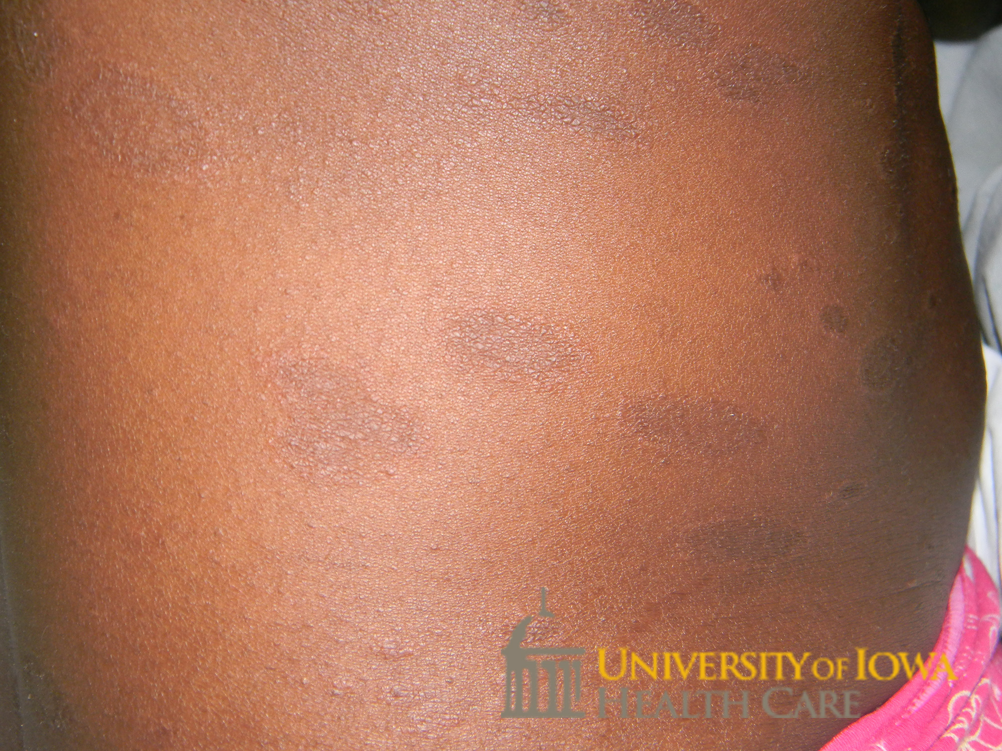 Ovoid gray-brown papules and plaques with fine scale. (click images for ...