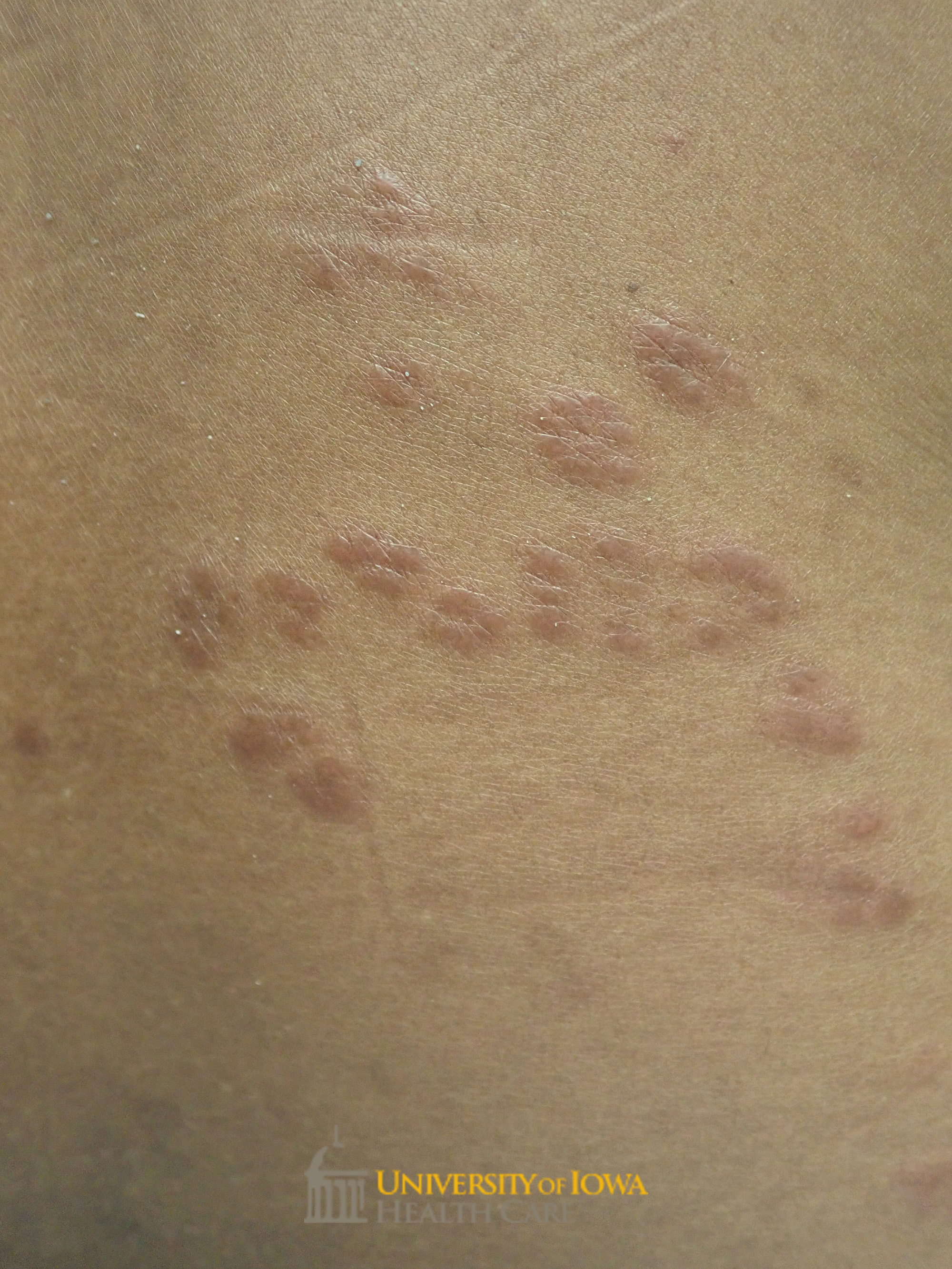 Shiny, red-brown clustered papules on the back. (click images for ...