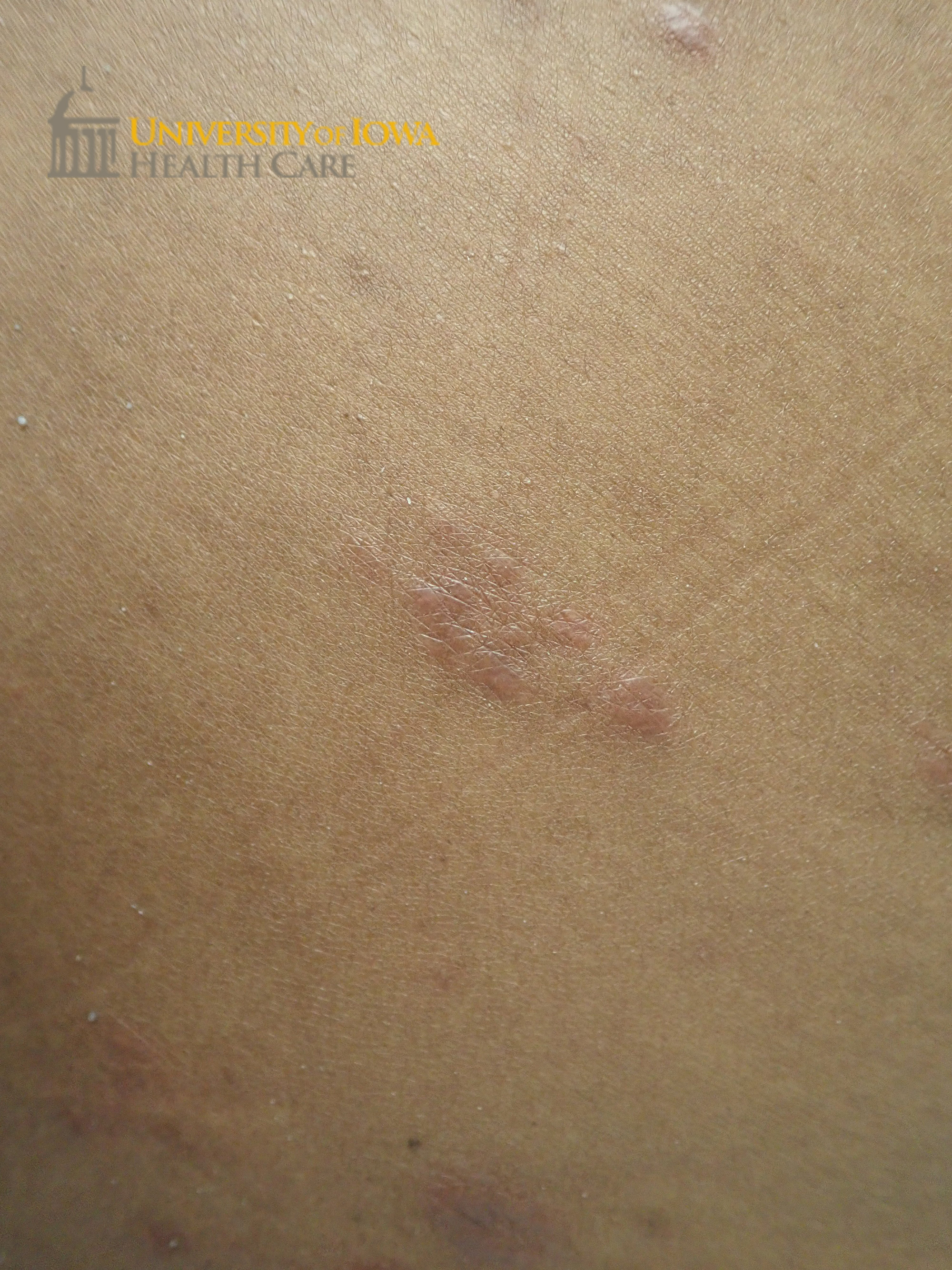 Shiny, red-brown clustered papules on the back. (click images for ...