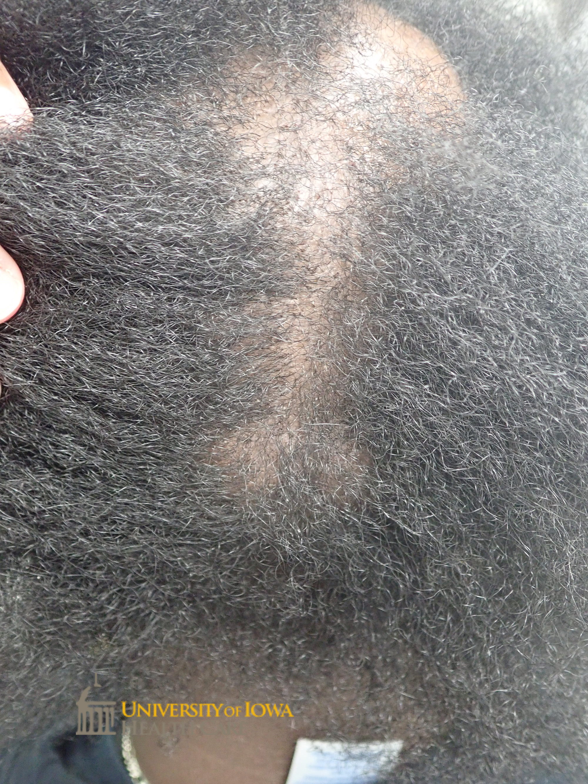 A large patch of scarring alopecia with irregular borders and with some ...