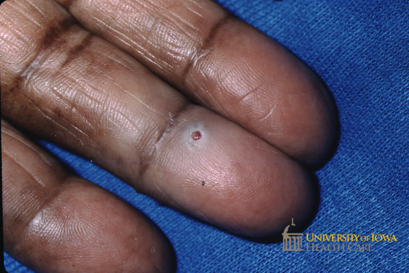 Red papule with macerated collarette of scale on the 3rd ventral finger ...