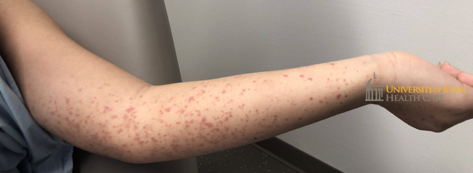 Purpuric papules on the upper extremity. (click images for higher ...