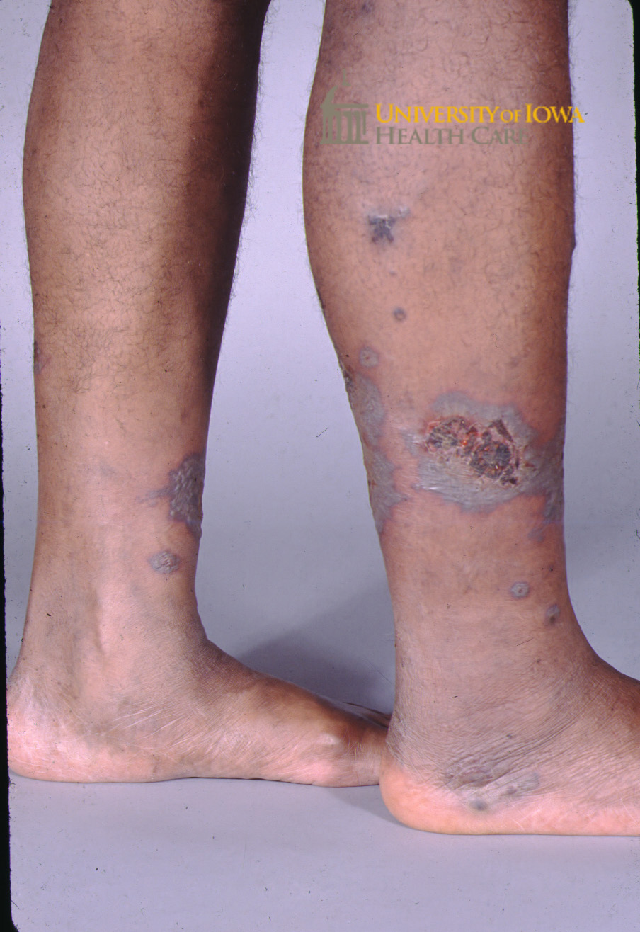 Violaceous retiform plaques with central ulceration and eschar on the ...