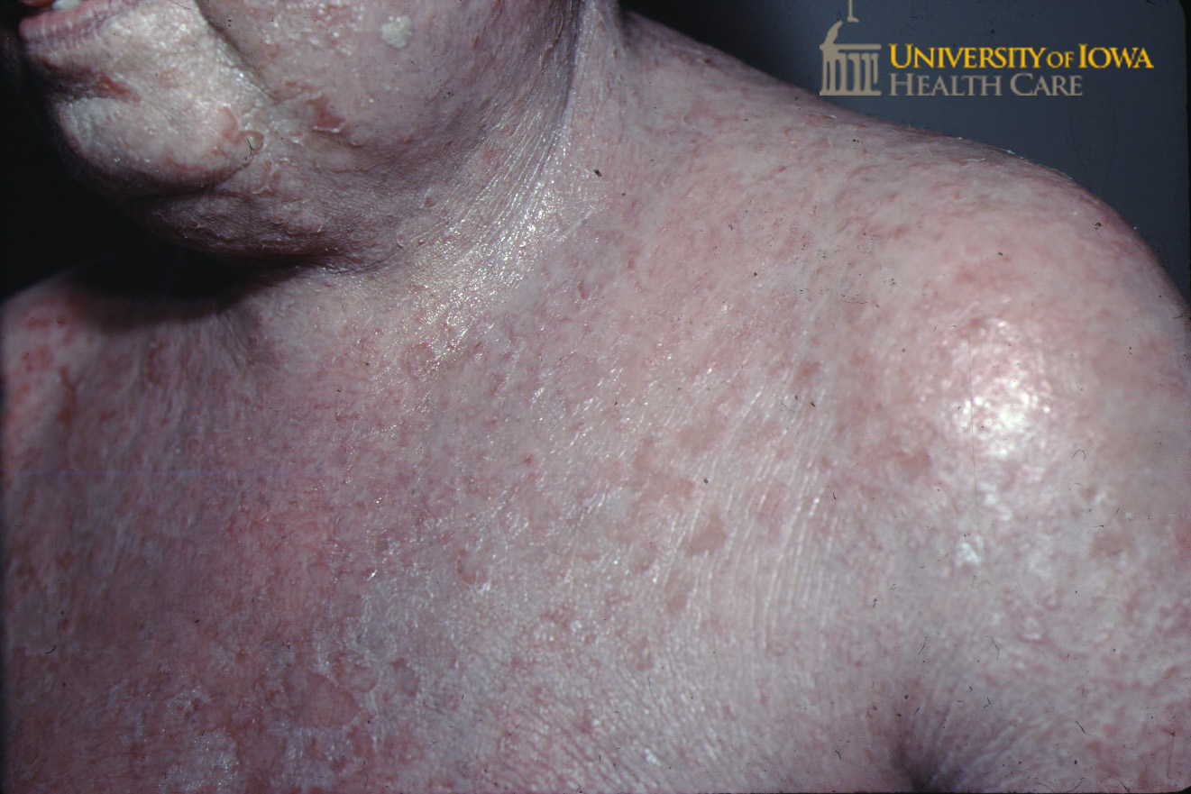 Widespread superficial erosions, some with crust, and few flacid bullae ...